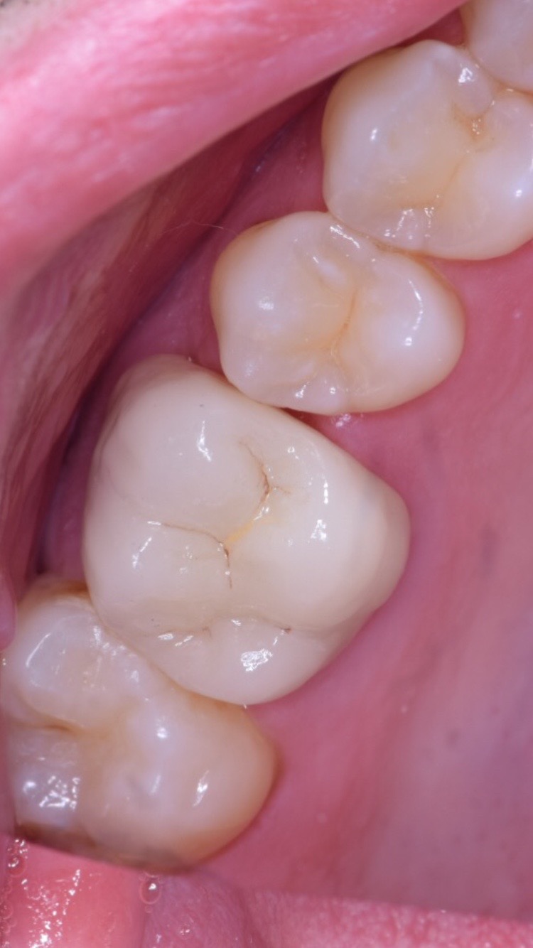 General Dentistry – Dental Devitalization – cabinet neuilly dentaire