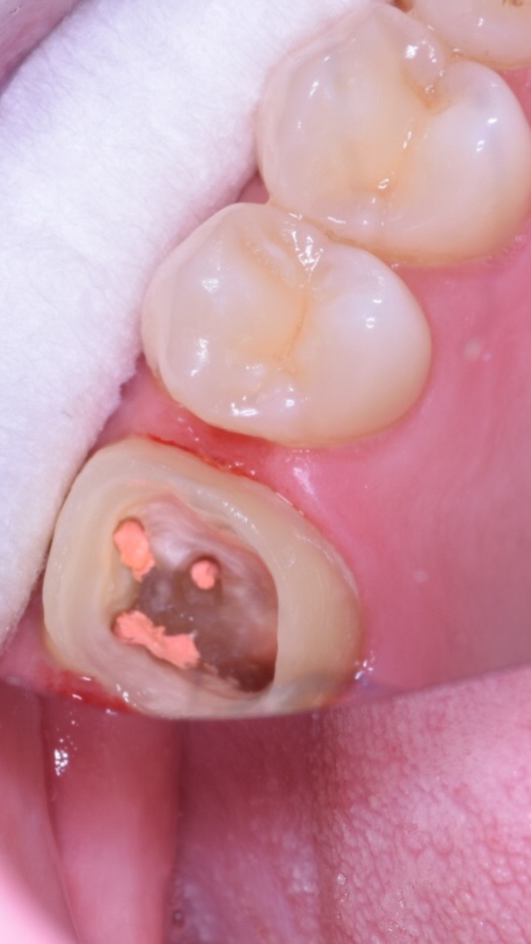 General Dentistry – Dental Devitalization – cabinet neuilly dentaire