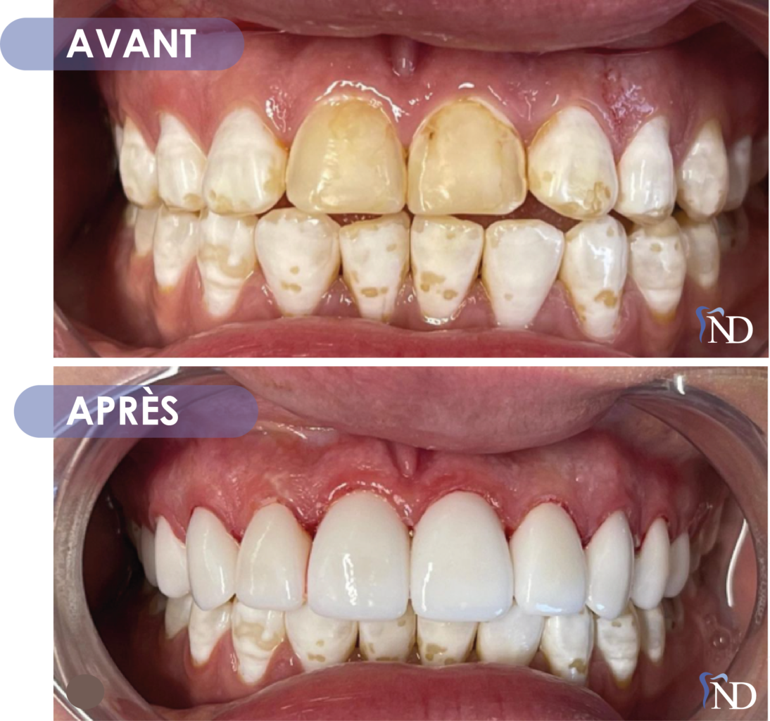 Fluorose, avant/après – cabinet neuilly dentaire